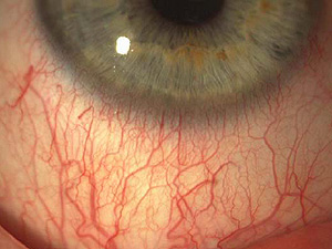 Hochleistungshydrogel oder Silikonhydrogel - Wann passe ich was an ...