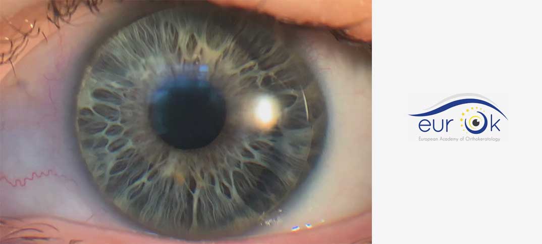 EurOk unterstützt bei Orthokeratologie und Myopiekontrolle - optikum ...